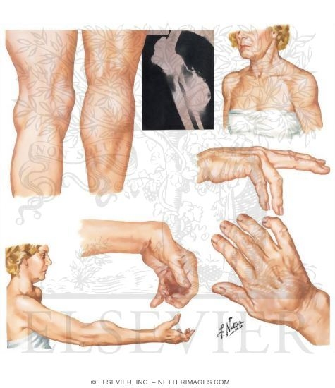 Extraarticular Manifestations In Rheumatoid Arthritis