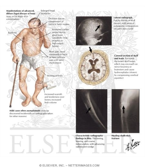 Pagets Disease Of Bone