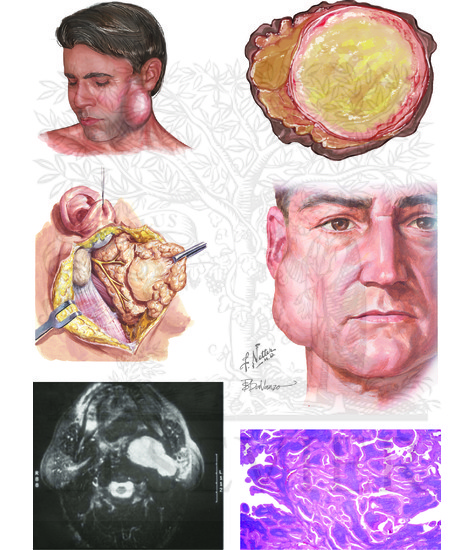 Benign Tumors Of The Salivary Glands