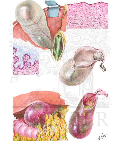 Hydrops And Empyema Of Gallbladder