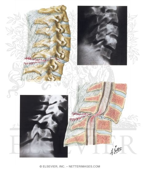 Dislocations of Cervical Spine