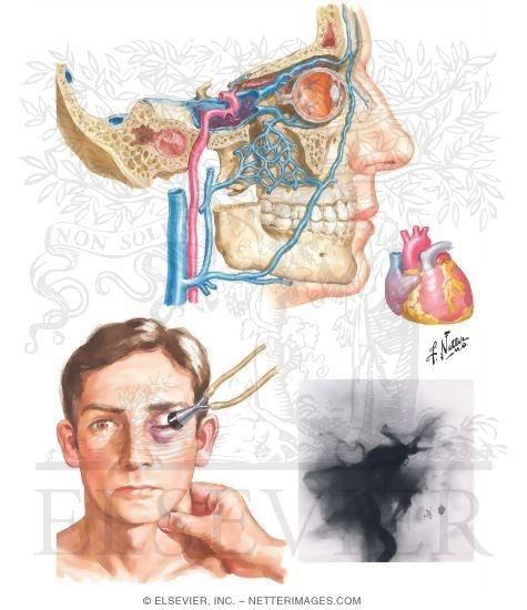 Carotid-Cavernous Arteriovenous Fistula
