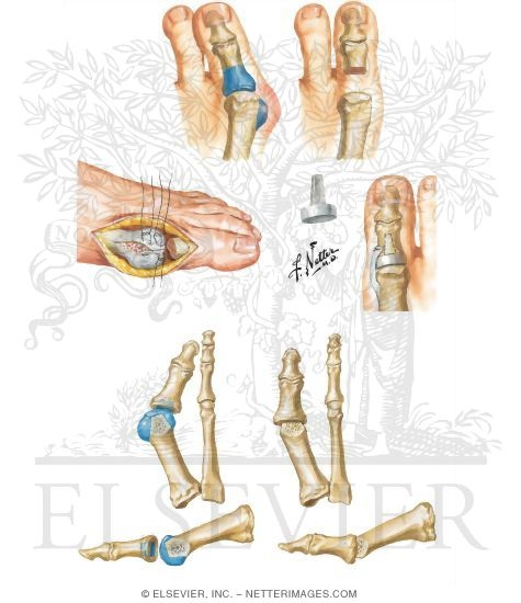 Surgical Procedures for Toe Deformities