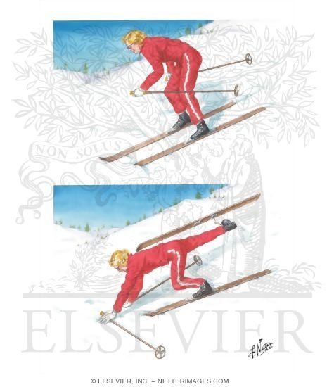 Mechanism of Forward Fall and "Boot Top" Fractures