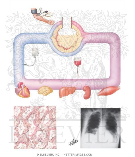 Posttraumatic Pulmonary Insufficiency (Adult Respiratory Distress ...