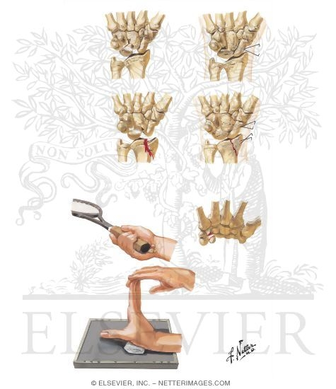 Dislocation of Carpus, Fracture of Hamulus (Hook) of Hamate
