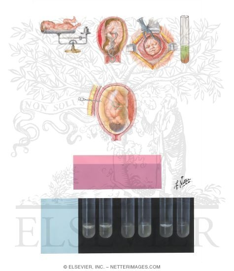 Risk Factors for Development of Hyaline Membrane Disease - Prenatal ...
