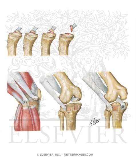 Rupture of Anterior Cruciate Ligament