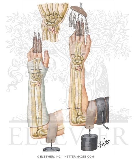 Percutaneous Pin Fixation and Plaster Cast Immobilization of Comminuted ...