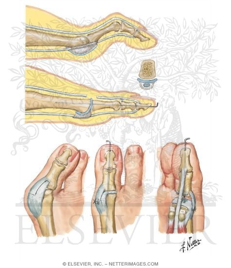 Plantar Ligament (Plate) Interpositional Arthroplasty for Lesser Toes ...