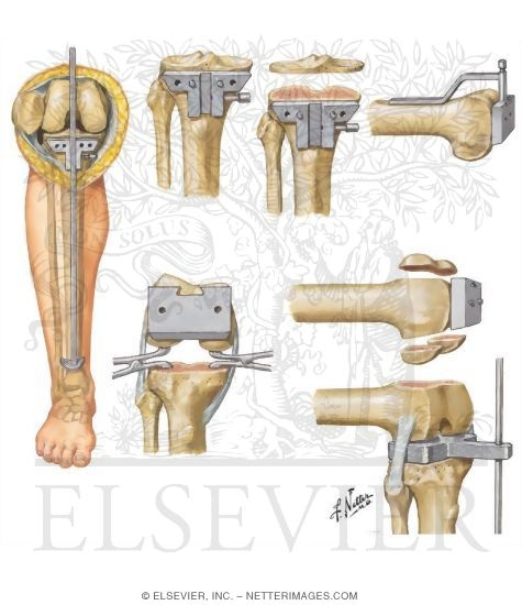 Technique for Total Knee Replacement