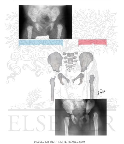 Radiologic Diagnosis of CDH