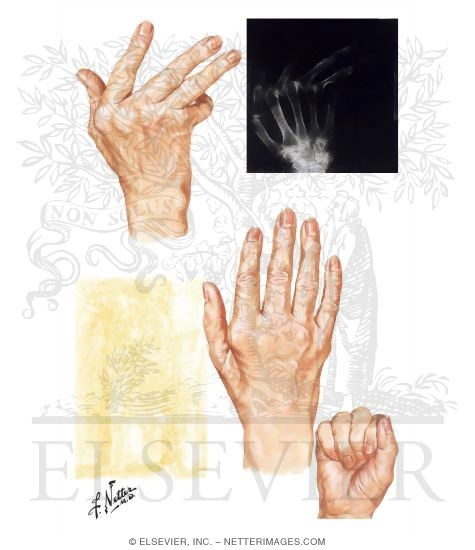 Metacarpophalangeal Joint Disabilities