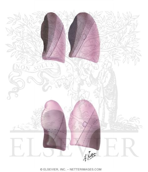Patterns of Lobar Collapse; Left Lung (after Lubert and Krause)