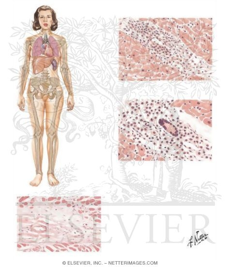 Myocarditis In Sarcoidosis and Scleroderma