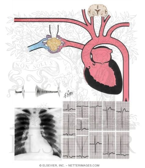 Aortic Insufficiency Manifestations of Aortic Insufficiency Valvular ...