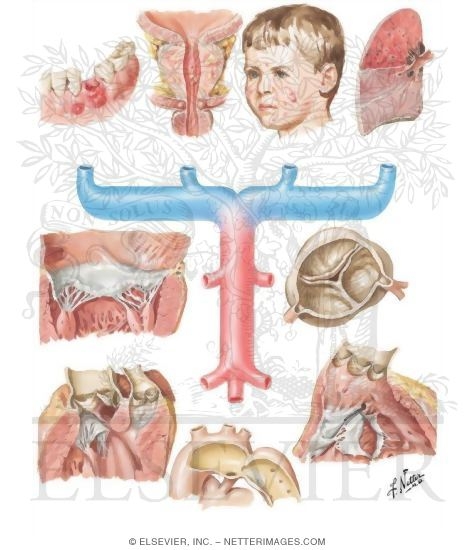 Bacterial Endocarditis - Portals of Entry and Predisposing Lesions