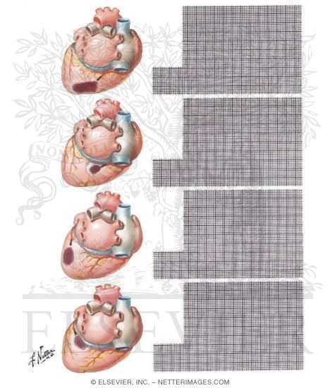 Localization of Posterior Infarcts