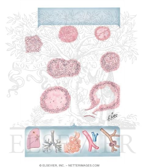 Evolution of Tubercle