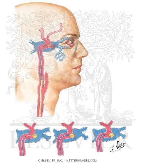 Balloon Embolization of Carotid-Cavernous Fistula