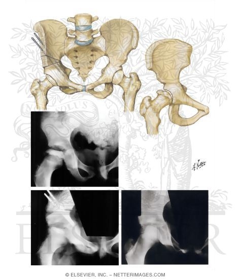 Innominate Osteotomy