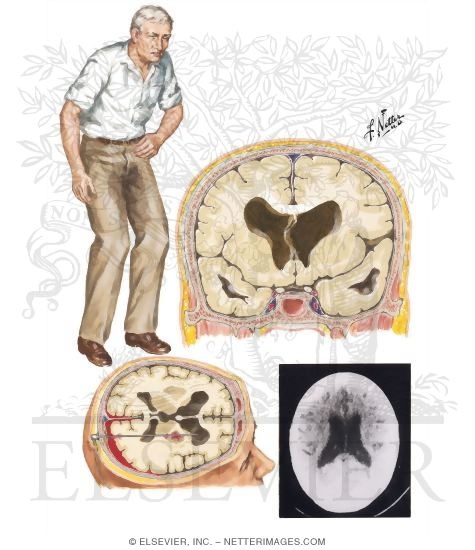 Normal Pressure Hydrocephalus