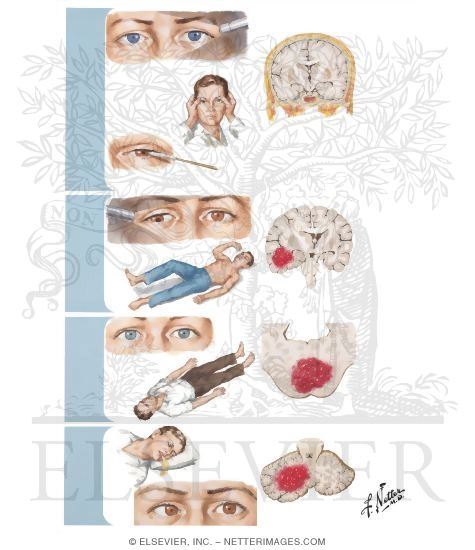 Differential Diagnosis of Coma