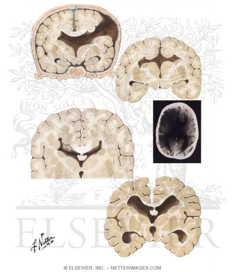 Brain Malformations