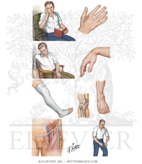 Other Compressive or Entrapment Neuropathies