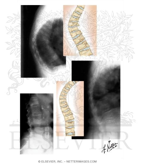 Radiographic Findings In Axial Osteoporosis