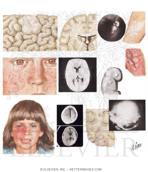 Tuberous Sclerosis