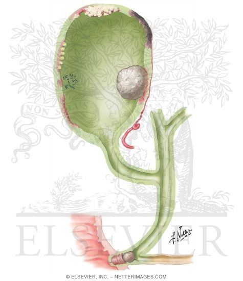 Interrelation of Gallbladder Diseases