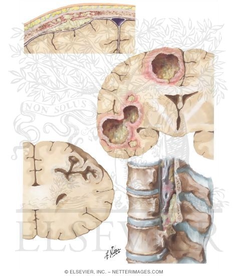 Abscess of Brain and Spine