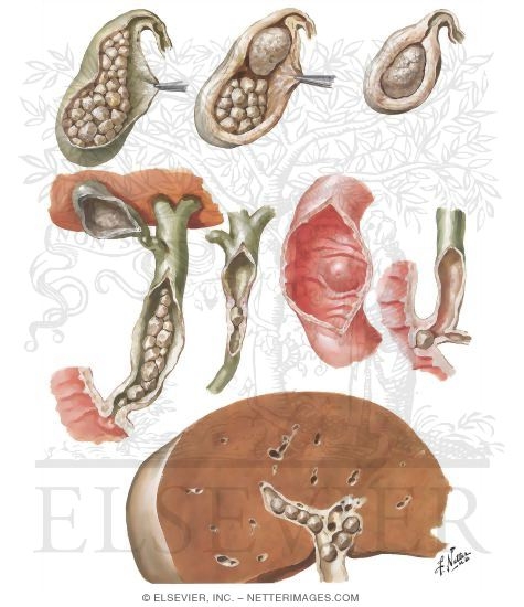 Cholelithiasis III - Pathologic Features, Choledocholithiasis