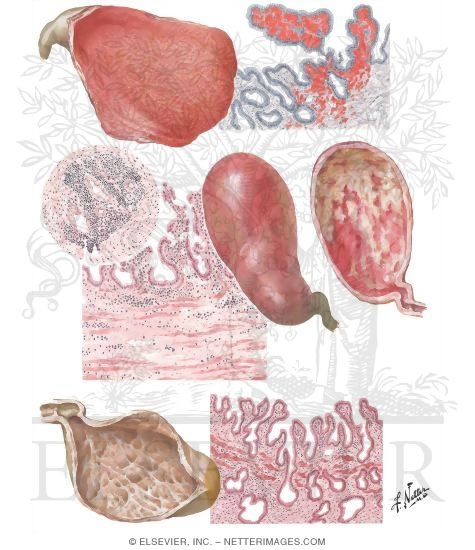 Cholecystitis I - Acute and Chronic