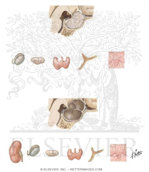 Severe Anterior Pituitary Deficiency or Panhypopituitarism