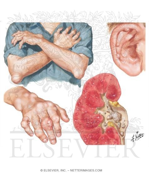 Clinical Aspects of Gout