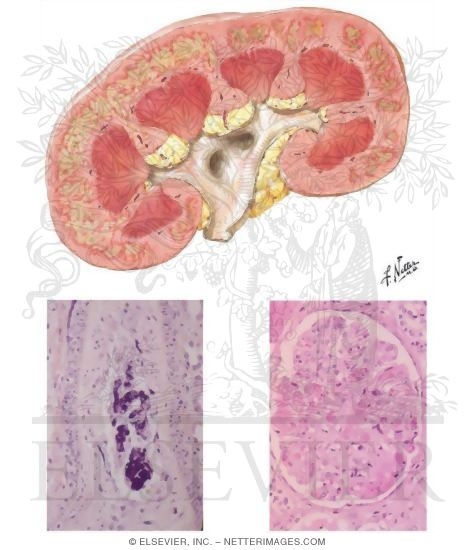 Hemolytic-Uremic Syndrome (Intravascular Coagulation and Thrombotic ...