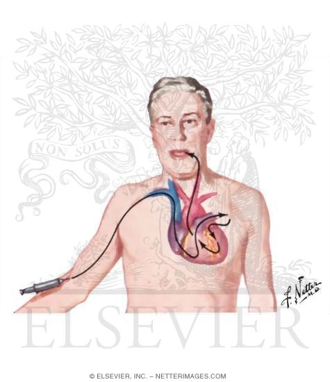 Left Heart Failure and Pulmonary Congestion