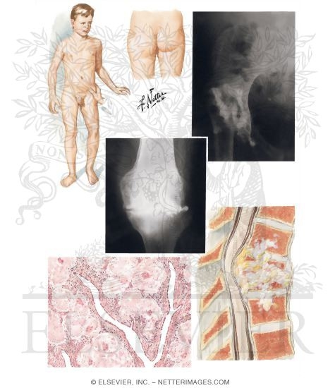 Tuberculous Arthritis