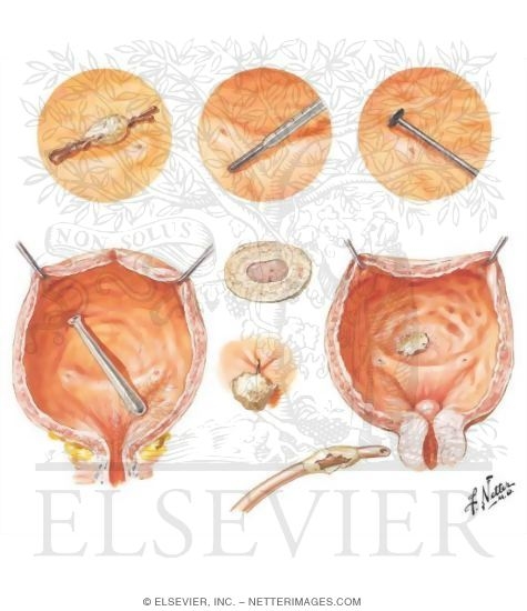 .Medical Coding Foreign Body | Coding Clarified