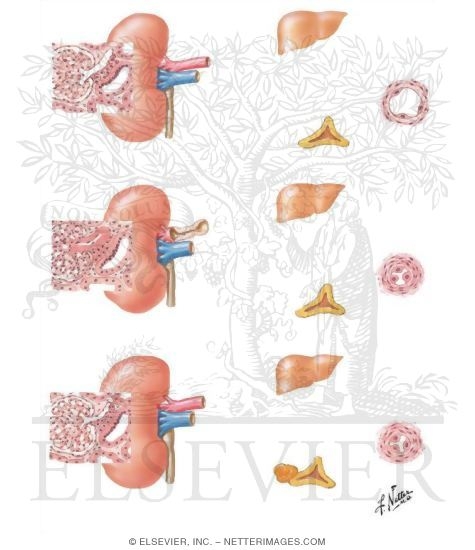 Renovascular Hypertension
