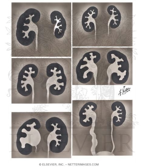 intravenous pyelogram