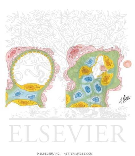 Hypothesis of Pathogenesis of Acute Glomerular Injury By Circulating ...