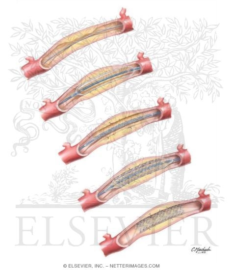 Performance of Percutaneous Coronary Intervention: Stent Deployment