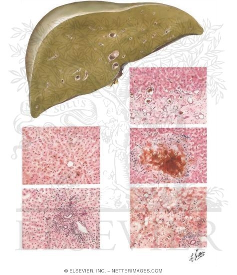 Extrahepatic Biliary Obstruction II - Stages