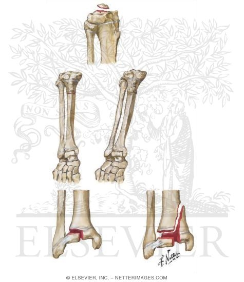 Fracture of Tibia in Children