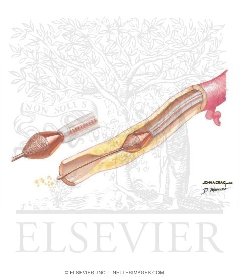 Rotational Atherectomy
