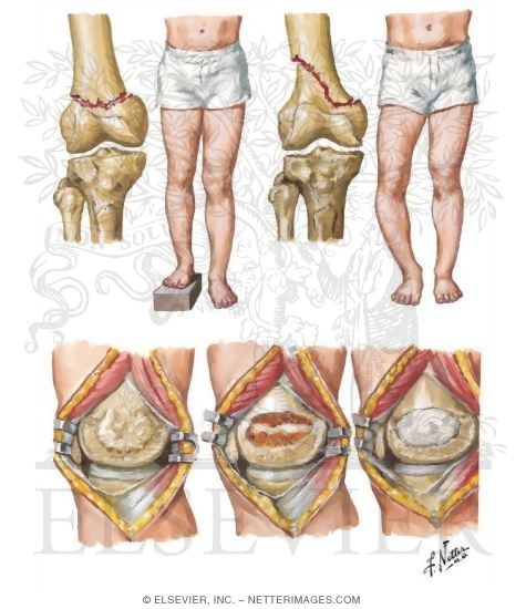 fracture bone growth