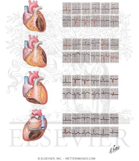Localization of Myocardial Infarcts